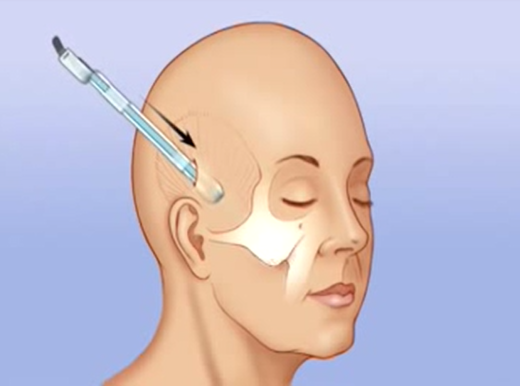 Endotine Midface – Promeduc Surgical AB