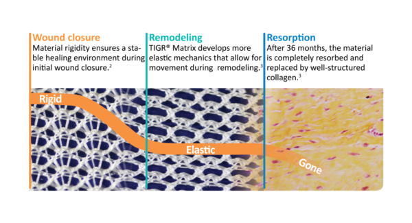 TIGR® Matrix – Promeduc Surgical AB