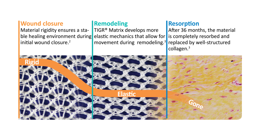 TIGR® Matrix – Promeduc Surgical AB
